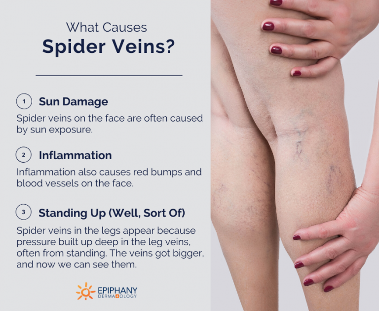How To Get Rid Of Spider Veins On Your Legs Face Feet how-to-get-rid-of-spider-veins-on-your-legs-face-feet