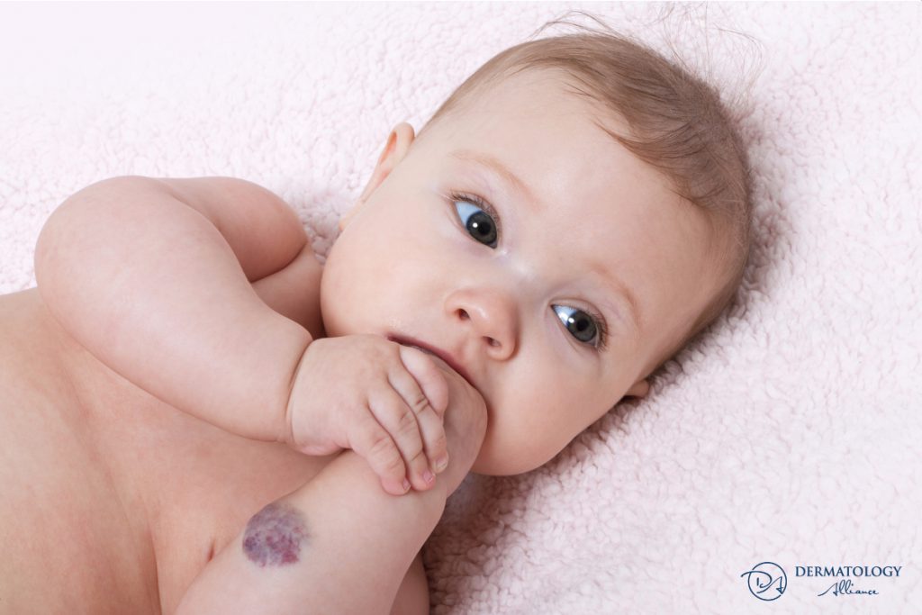 The Facts About Your Baby’s Strawberry Birthmark