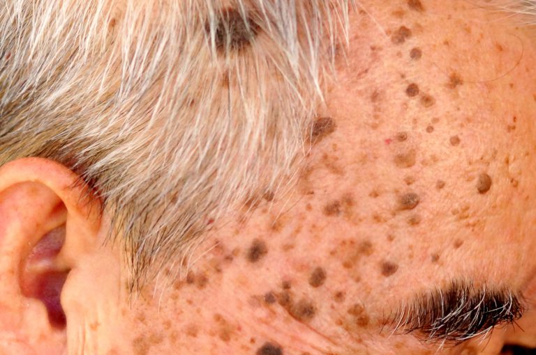 What Is Seborrheic Keratosis And Can It Be Removed?
