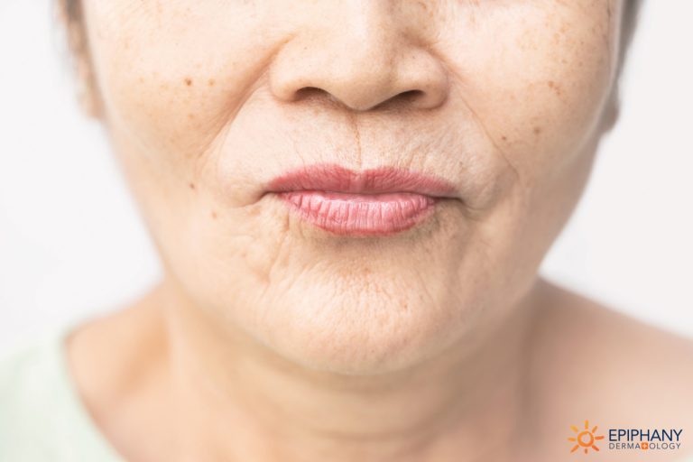 How to Get Rid of Embarrassing Lip Lines Around the Mouth