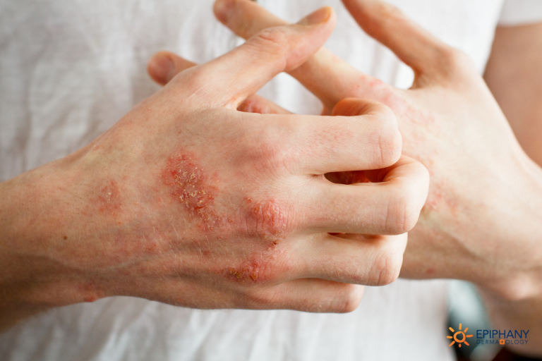 Red Scaly Rash Here s Why You Need A Dermatologist To Diagnose You Red Scaly Rash Here s Why You Need A Dermatologist To Diagnose You