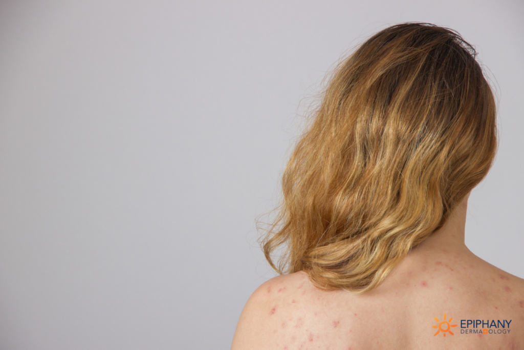 How to Treat Teenage Acne & Other Teen Skincare Problems