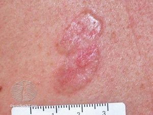 Red, Scaly Rash? Here's Why You Need A Dermatologist to Diagnose You