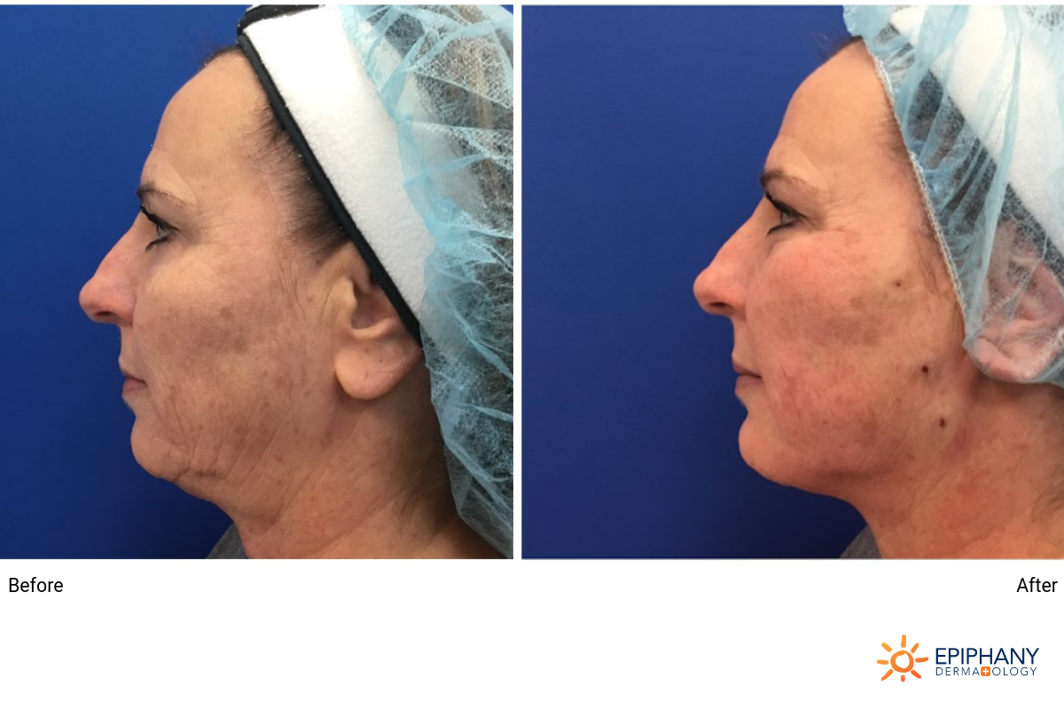 Before And After Threadlift Epiphany Dermatology