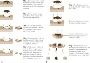 Why Mohs Surgery Is the Standard of Care for Skin Cancer Treatment