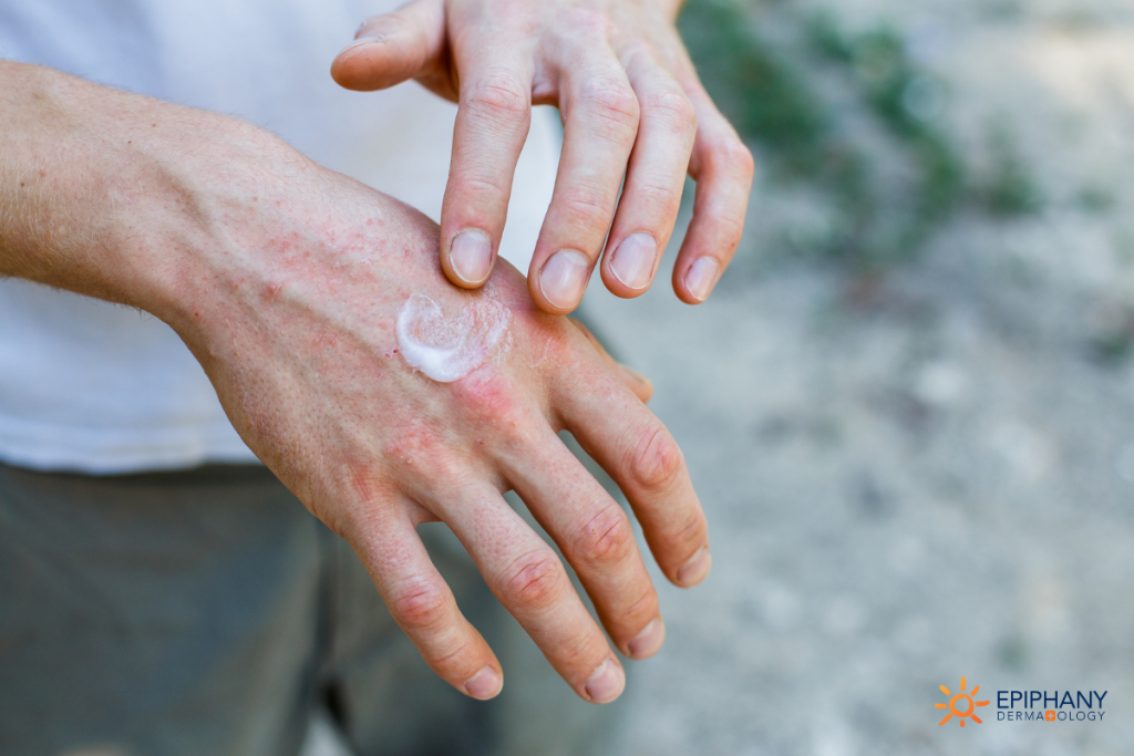 The Simple Guide to Actinic Keratoses | Epiphany Dermatology