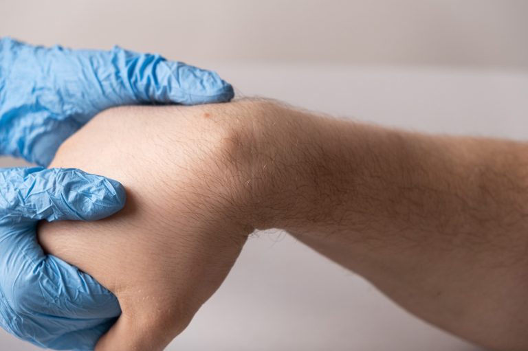 Lipoma Removal | Epiphany Dermatology